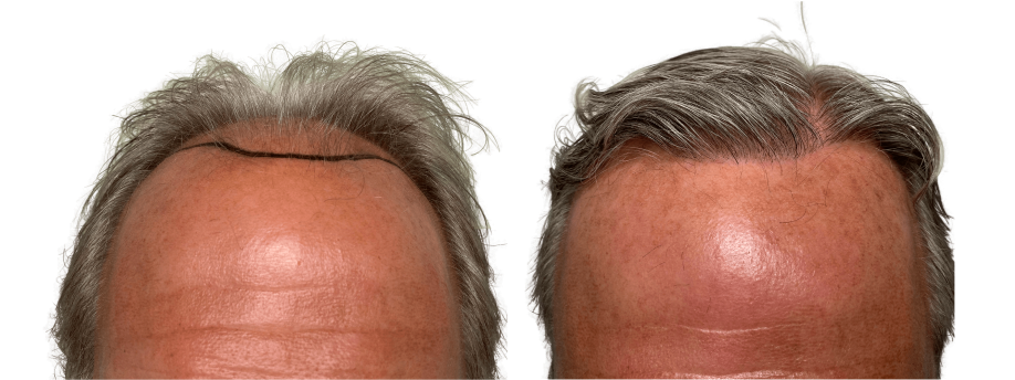 Hair Transplants & Restoration | MAXIM Hair Restoration