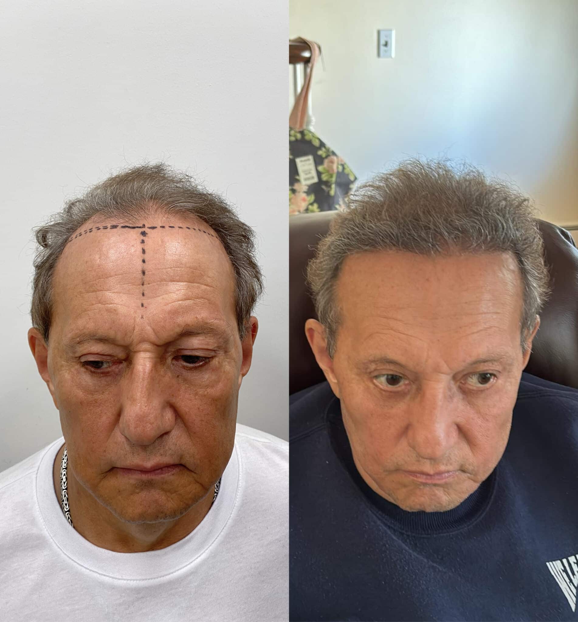 Maxim Hair Restoration: Transform Your Look
