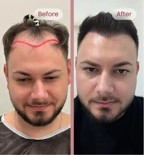 Maxim Hair Restoration: Transform Your Look